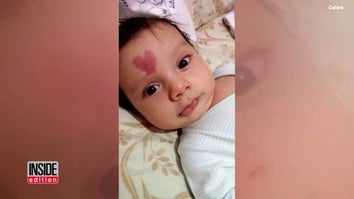 heart birthmark