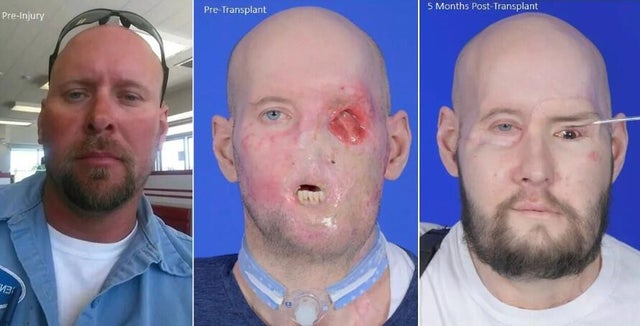 electrical burns face