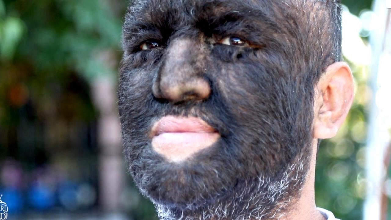 Meet the World's Hairiest Man | Inside Edition